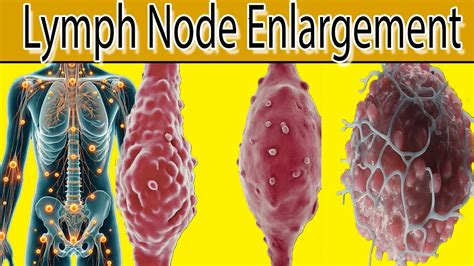 Lymph Node Enlargement 7 Most Common Causes Youtube