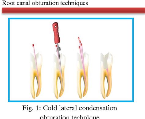 Figure 1 From Cold Lateral Condensation Versus Other Root Canal Obturation Techniques A Review