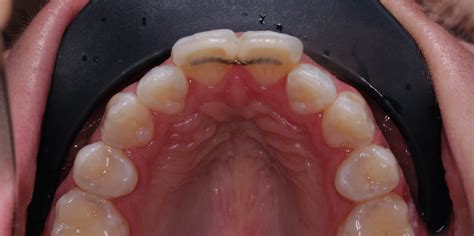 Invisalign Smile Gallery Dentist New Malden Private Dentist Wimbledon