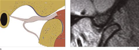 Figure 12 From Tmd Clinical Diagnostic Classification Temporo Mandibular Disorders Semantic