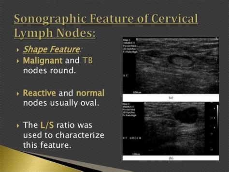 Imaging Of Enlarged Lymph Node