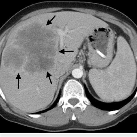 Pdf Successful Management Of An “unresectable” Intrahepatic