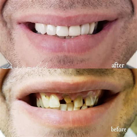 ‎دکتر سحر جمشیدیدندانپزشکابهر‎ ‎بستن فاصله ی بین دندان ها به وسیله