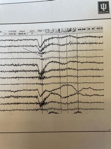 Normal EEG Flashcards Quizlet Normal EEG Flashcards Quizlet