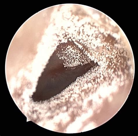 Ear Canal Lavage For Curing Noninvasive Otomycosis A Randomized