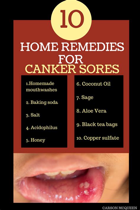 Canker Sores And Home Remedies For Treatment Artofit