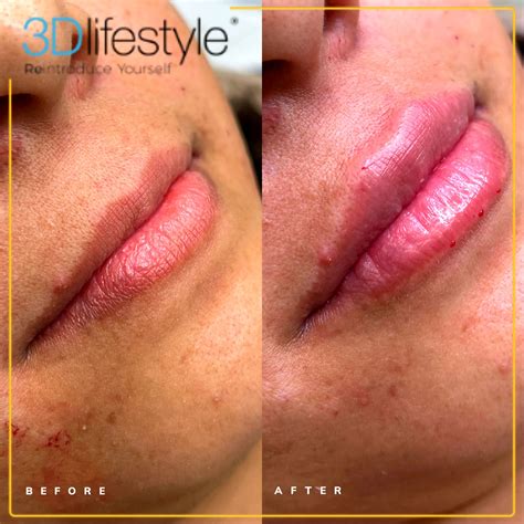 Dermal Fillers Vancouver 3d Lifestyle