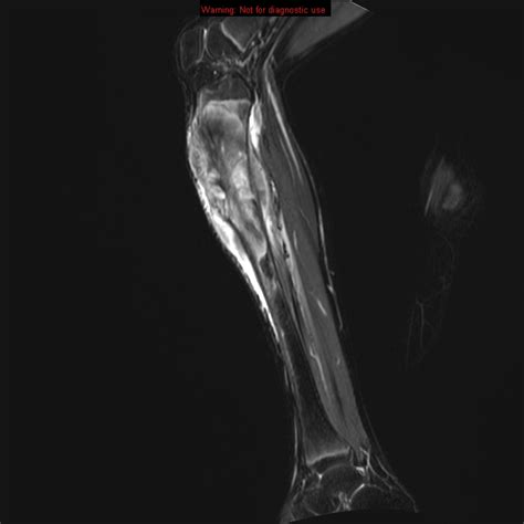 Osteosarcoma Proximal Tibia Image