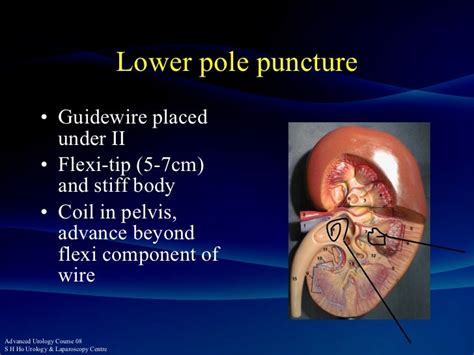 Pcnl The Perfect Puncture
