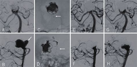 Pre And Postoperative Findings Of Pulserider Assisted Coil Embolization Download Scientific
