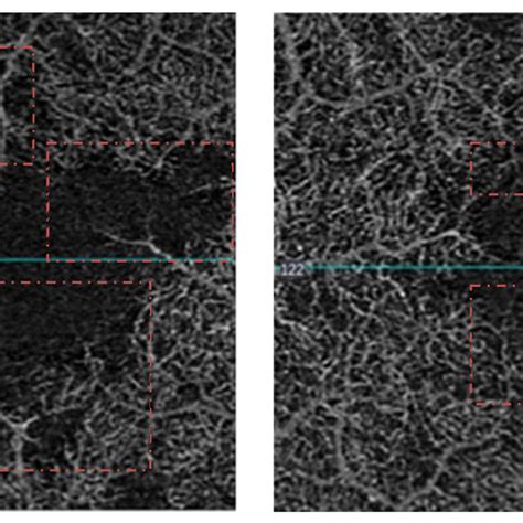 A Spectralis Macular Sd Oct Of The Right Eye Left Image And Left