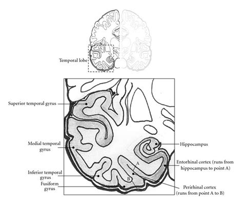 Coronal Section Of The Temporal Lobe Showing Key Structures Download Scientific Diagram