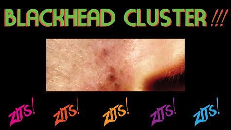 Blackhead Cluster Pimple Popping Never Before Seen Youtube