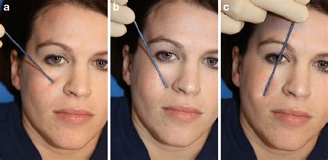 Infraorbital Nerve Block Landmarks