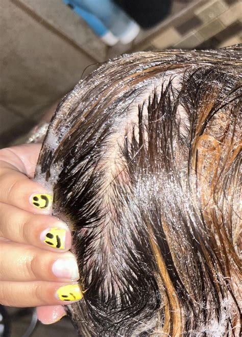 Dandruff Dry Scalp Psoriasis R Dandruff