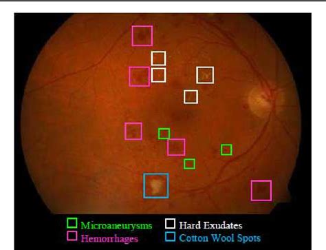 Figure 1 From Segmentation Of Exudates Via Color Based K Means Clustering And Statistical Based