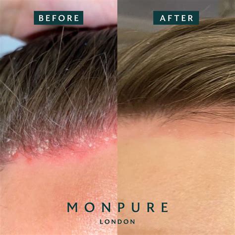 Psoriasis Scalp