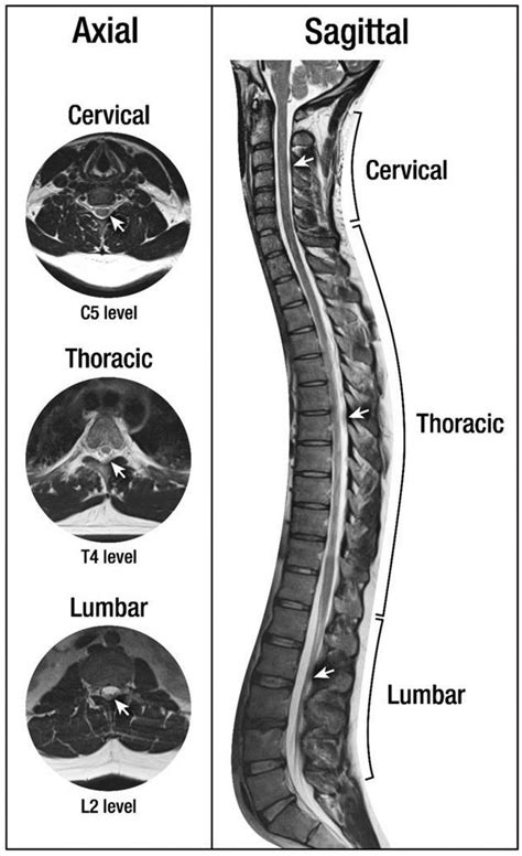 Cervical Spine Mri Labeled