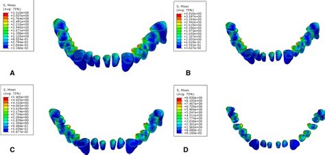 Cloud Chart Of A Finite Element Analysis Of A Periodontal Membrane Of