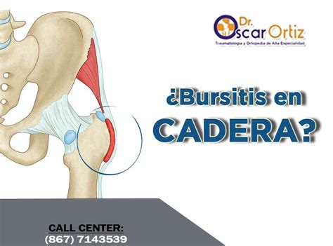 Síntomas De La Bursitis De Cadera Dr Oscar Ortiz López Facebook