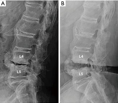 Spontaneous Symptomatic Lumbar Intervertebral Pseudoarthrosis Associated With Diffuse Idiopathic