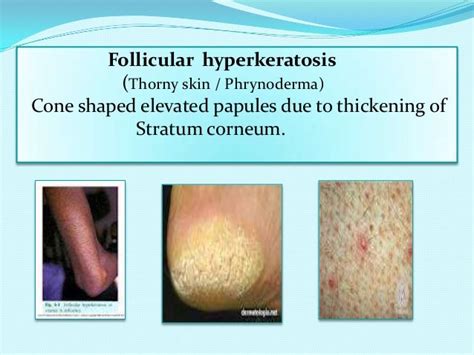 Follicular Hyperkeratosis Face