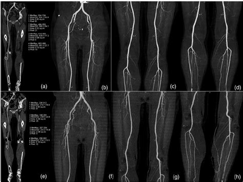 Lower Extremity Cta At 70 Kvp In A 60 Year Old Woman Ad And At 120 Download Scientific