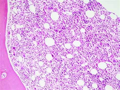 The Bone Marrow Histopathology Shows Hypercellularity Sparse Download Scientific Diagram