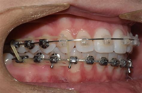 Tooth Braces Rubber Bands At Sandra Willis Blog
