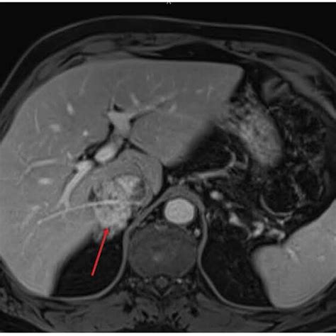 Pre Operative Mri Showing Involvement Of The Retro Hepatic Ivc By