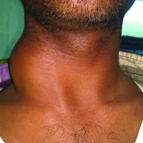 Pdf Follicular Dendritic Cell Sarcoma Of The Neck Recurring After