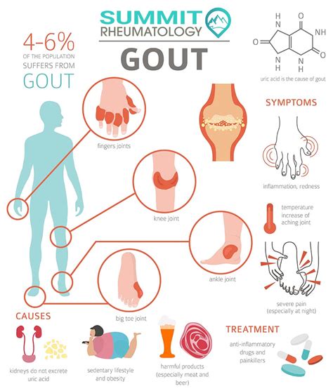 Gout Treatment Guide Summit Rheumatology