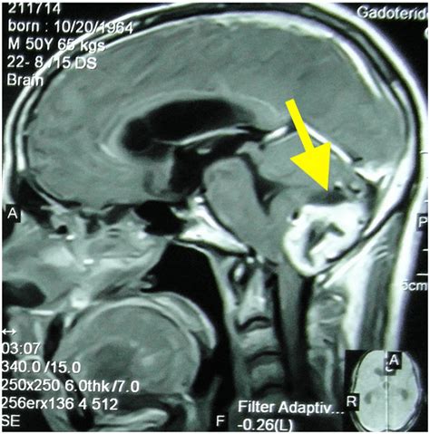 T1 Weighted Postcontrast Mri Showing Cerebellar Hemangioblastoma Arrow