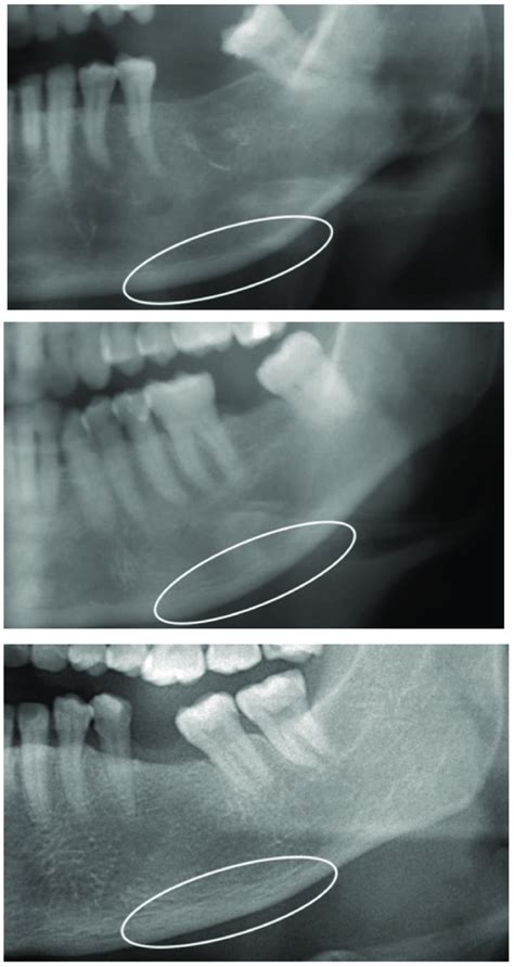 Mandibular Cortical Index Mci Participants Were Divided Into Three Download Scientific