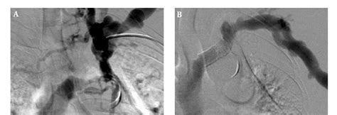 Figure 5 From Comparison Of Open Cell Stent And Closed Cell Stent For