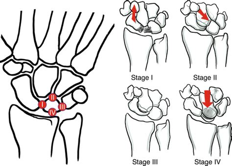 Lesser Arc Injuries Perilunate Dislocations Springerlink
