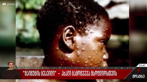 „მაიმუნის ყვავილი“ ახალი გამოწვევა მსოფლიოსთვის 1tv