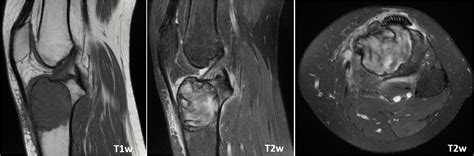 Tumor De Células Gigantes Tcg