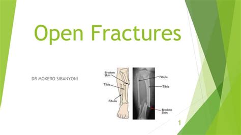 Open Fractures Pptx