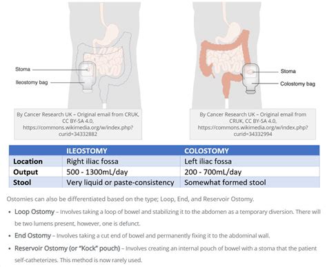 Ileostomy Vs Colostomy Comparison Ileostomy Location Grepmed