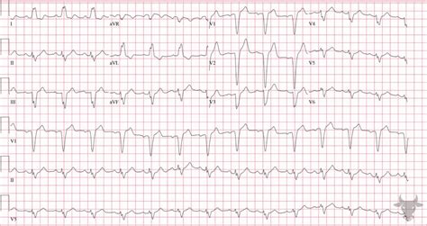 Left Bundle Branch Block ECG Stampede