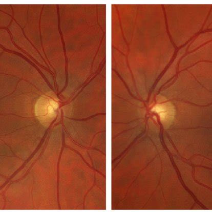 Right Eye On OCT Angiography The Superficial Capillary Plexus A And Download Scientific