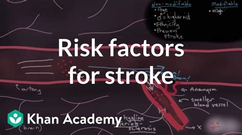 Stroke Risk Factors