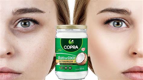 Utilize Imediatamente O óleo De Coco Nas Suas Manchas De Olheiras E