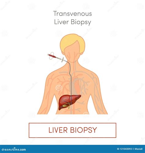Transvenous Liver Biopsy Stock Vector Illustration Of Care 121043093