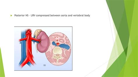Nutcracker Syndrome And Its Management Pptx