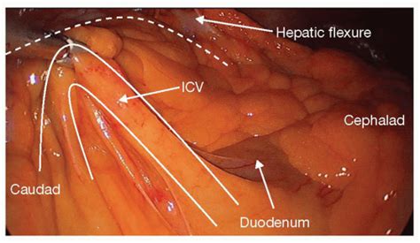 Restorative Proctocolectomy Single Incision Laparoscopic Technique