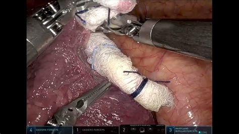 Robotic Left S1 2 Anatomical Segmentectomy Youtube