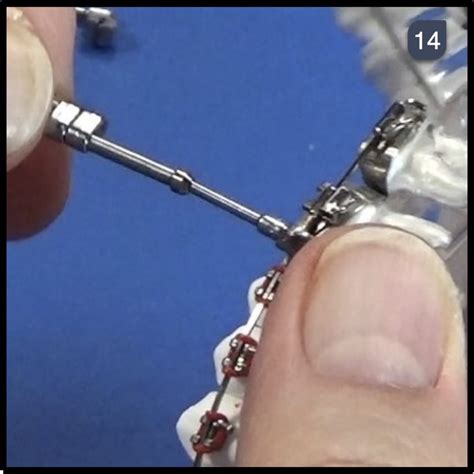 Orthodontic Demonstration Twin Force Bite Corrector Williams Gp Orthodontic Seminars