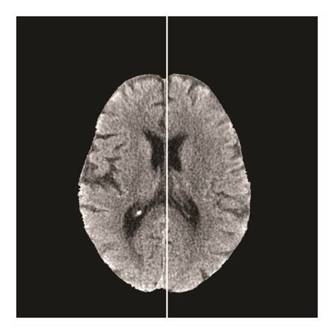 Schematic Framework For Segmentation Of The Brain Ventricle In Ct Of Download Scientific